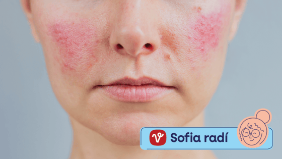 Rosacea: Ako vyzerá a dá sa vyliečiť?
